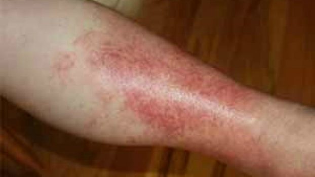 Celulitis infecciosa: síntomas y cómo prevenir este problema